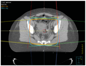 Three-dimensional conformal radiation therapy (3DCRT) - UCSF Department ...