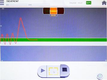 SDX breath monitoring system - UCSF Department of Radiation Oncology