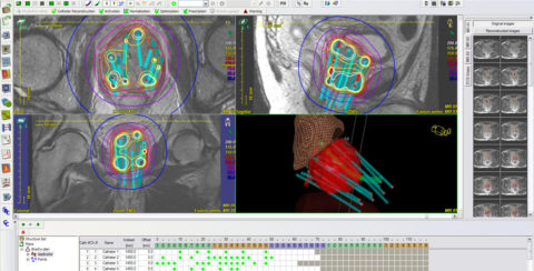 Brachytherapy (HDR & LDR) - UCSF Department of Radiation Oncology